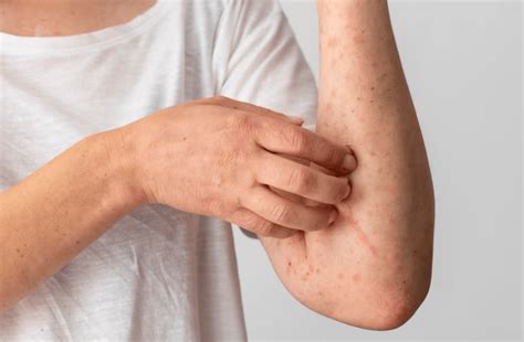 Urticaria Pigmentosa Symptoms And Treatments