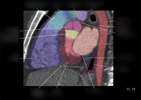 Radiology Case Stack 14 Sagittal Cardiac CT 8 Diagram Quizlet