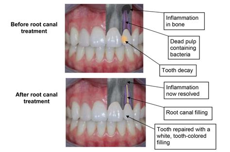 Surgical Endodonticroot Canal Treatment Newcastle Hospitals Nhs