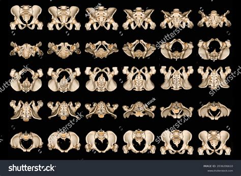 Ct Scan Pelvic Bone Both Hip Stock Illustration Shutterstock