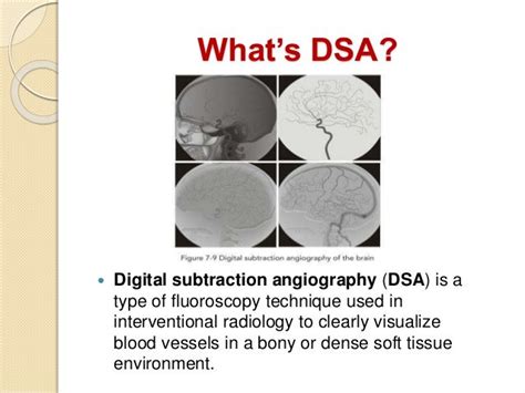 Digital Subtraction Angiography
