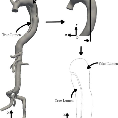 3 D Model Of The Aorta With A True And False Lumen Left 44 Cutting