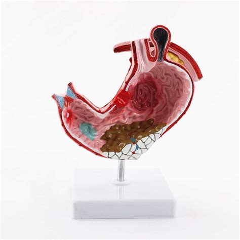 Research Model Anatomy Stomach Model Of Gastritis Model Of Gastric