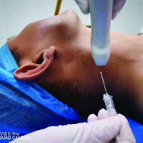 Position Of The Ultrasound Probe And The Needle During The Procedure Of Download Scientific