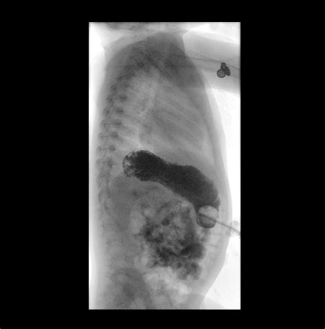 Gastrostomy Or Jejunostomy Rxrays