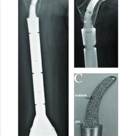 A Case Of Reconstruction Of The Femoral Diaphysis Following Femoral Download Scientific