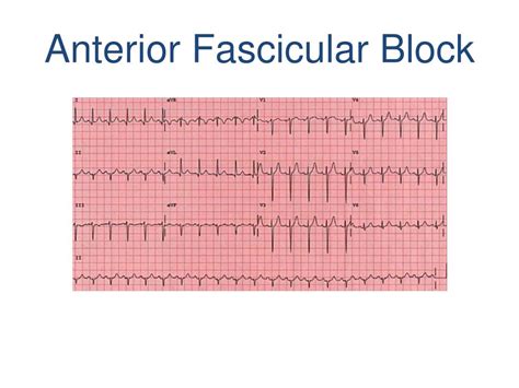 PPT Bundle Branch Blocks PowerPoint Presentation Free Download ID