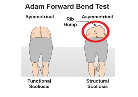 Scoliosis Spinedrx