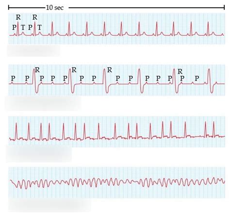 Cardio Ekg Patterns Diagram Quizlet