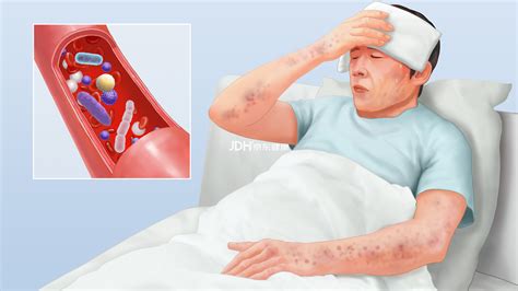 败血症 疾病百科 概述