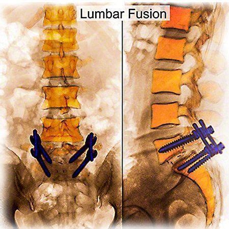 Lumbar Spinal Fusion Recovery Artofit
