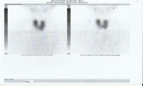 Study Of Thyroid Scan Of Patient 9 With Id 18 87 24 Sex M Download