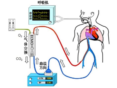 从肺炎患者救治看ecmo的应用和发展 新沃投研手机新浪网