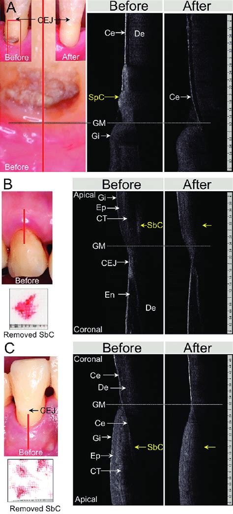 Subgingival Calculus