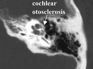 Ctmri Otosclerosis