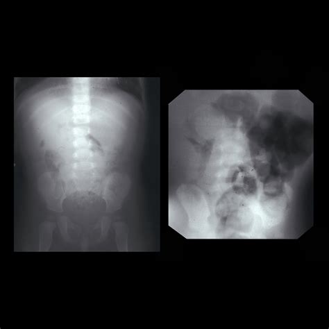 Intussusception X Ray Target Sign