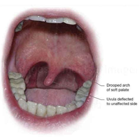 Dbmci Egurukul After Asking A 47 Year Old Woman To Open Her Mouth