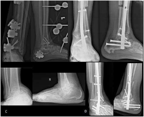Radiograph Of Left Tibia And Fibula Post Ankle External Fixator A And Download Scientific