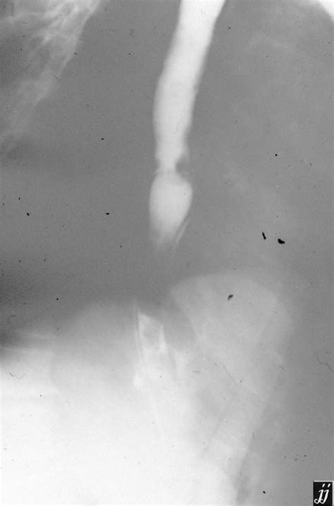 Abdomen Esophageal Scleroderma Radioogle