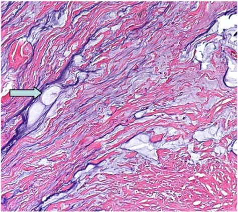 The Pathological Findings Of The Resected Appendix Extra Cellular
