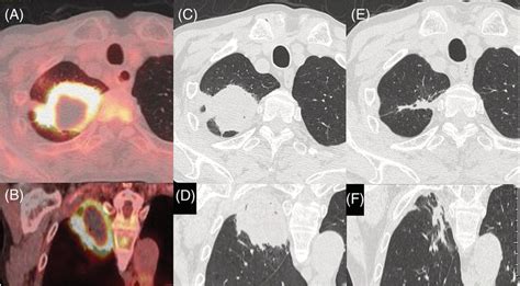 18 F‐fluorodeoxyglucose Positron Emission Tomography Computed Download Scientific Diagram
