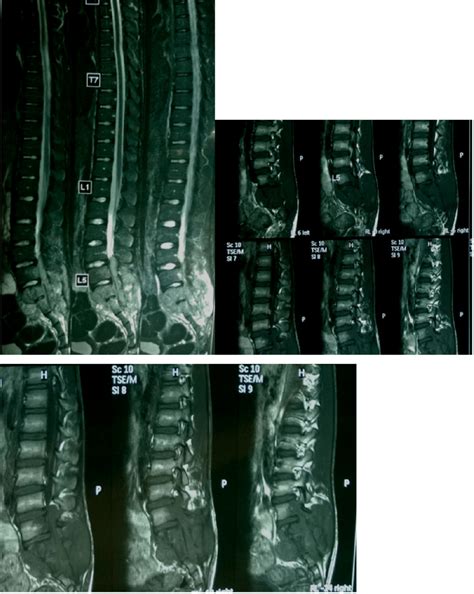T1 And T2 Weighted Sagittal Cuts Of The L S Spine Showing A Typical