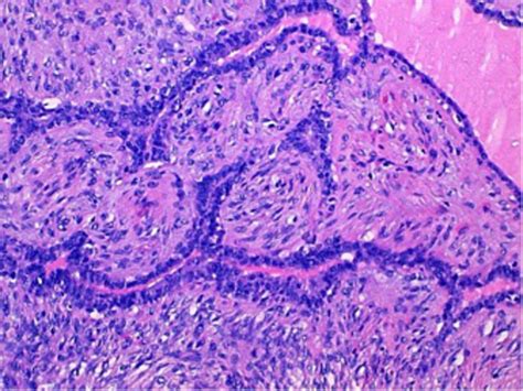 Case 7 Borderline Phyllodes Tumor This High Power View Demonstrates Download Scientific