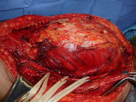Myxoid Liposarcoma Tumor Surgery Network
