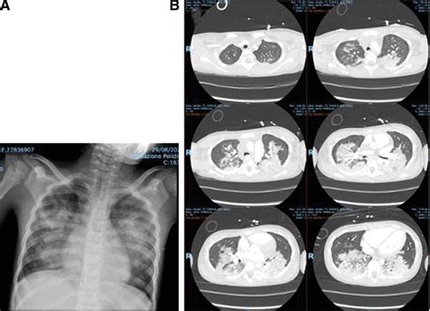 Rafael Jiménez Alés On Linkedin Complicated Falciparum Malarial Ards