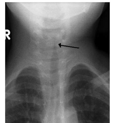 Rsvpertussiscroupbronchitis Part 1 Flashcards Quizlet