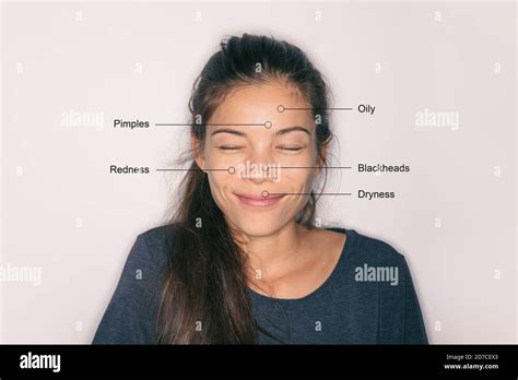 Skin Care Problems Asian Woman With Skincare Conditions Oily Forehead