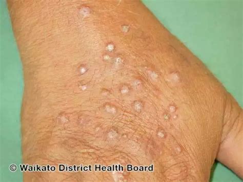 Asthma With Itchy Skin Rash 5 Skin Conditions To Know Myasthmateam