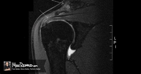 Does Subacromial Decompression Surgery Really Do Anything