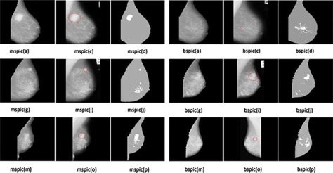 Segmentation Results For The Spiculated Masses In Mini Mias Mammograms Download Scientific