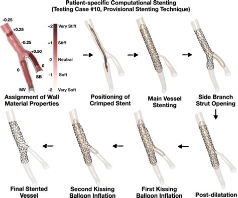 Representative Computational Stent Simulation Of A Clinical Case Download Scientific Diagram