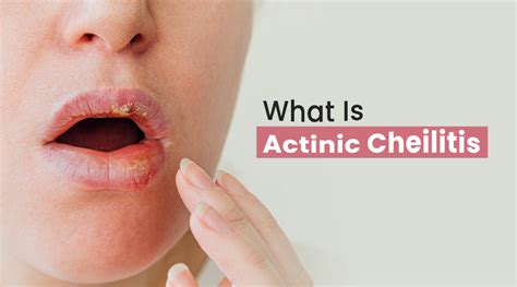 Is Actinic Cheilitis Curable In Vietnam