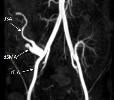 Three Dimensional Maximum Intensity Projection Mr Angiogram Showing The