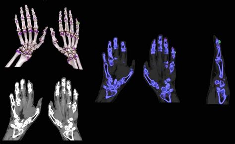 Advanced Gout Diagnosis With Dual Energy Ct Sunshine Coast