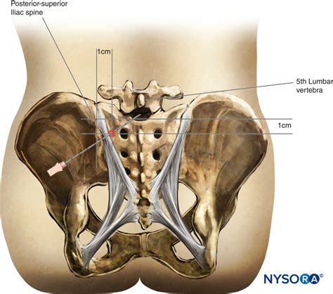 Spinal Block