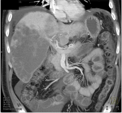 Multifocal Cholangiocarcinoma With Ascites Liver Radiology Case