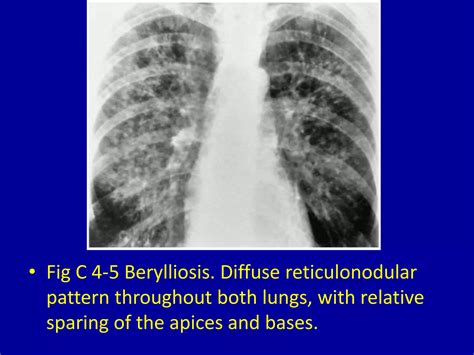 4 Diffuse Reticular Or Reticulonodular Pattern Pptx