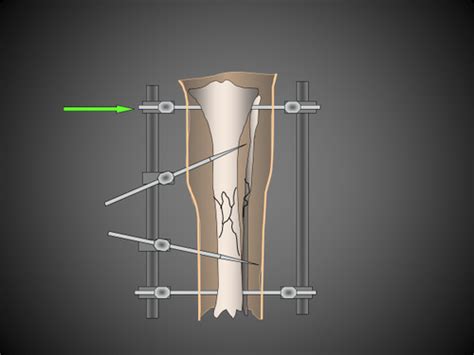 Principles Of External Skeletal Fixation Flashcards Quizlet