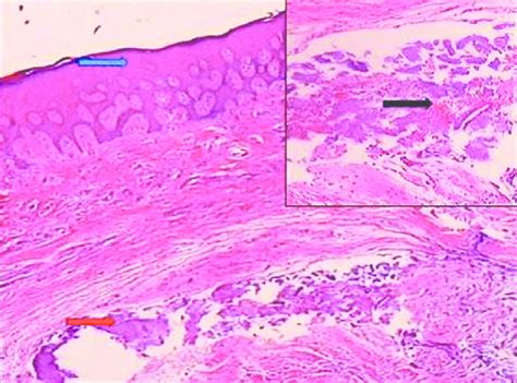 Gingival Specimen After 2 Weeks In Contact With Silorane‑ Based Download Scientific Diagram