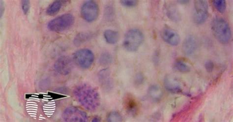 Toxoplasmosis Pathology Image