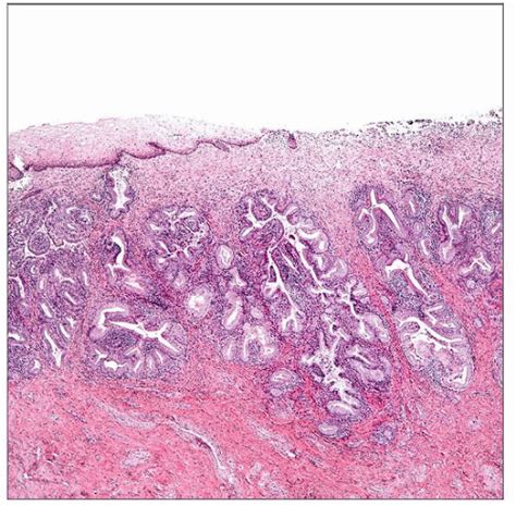 Endocervical Glandular Hyperplasia Diffuse And Lobular Basicmedical Key