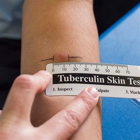 What Does A Positive Tuberculin Skin Test Mean At Tara Padgett Blog