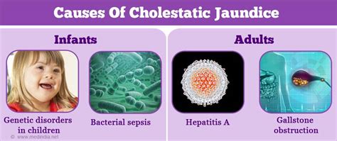 Cholestatic Jaundice Causes Symptoms Risk Factors Diagnosis Treatment Prevention