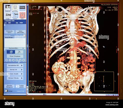 Aorta Artery Rib Cage Cat Computerized Axial Tomography Scan