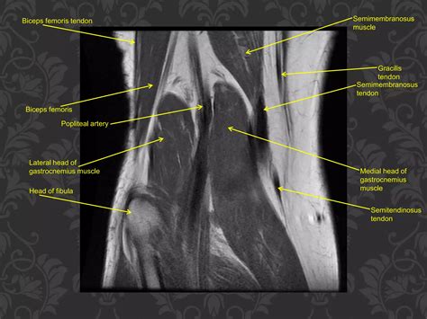 Mri Knee Of Orthopedic Importance Pptx
