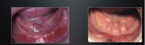 Lecture 7 Selection And Setting Of Posterior Teeth Flashcards Quizlet